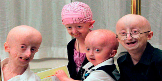 Understanding Progeria (Hutchinson-Gilford Syndrome): Causes, Symptoms ...